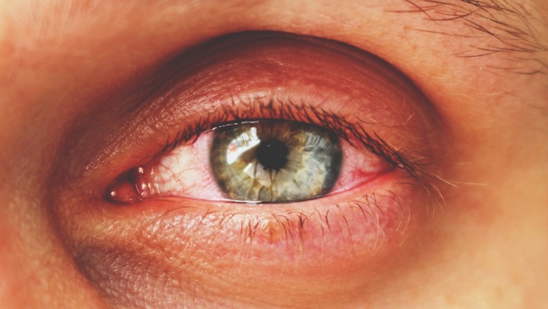How to Manage and Prevent Pink Eye